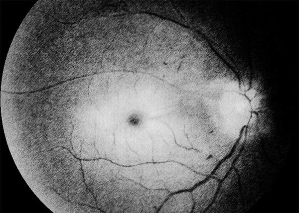 Retinal Artery Occlusion – Retyne.com