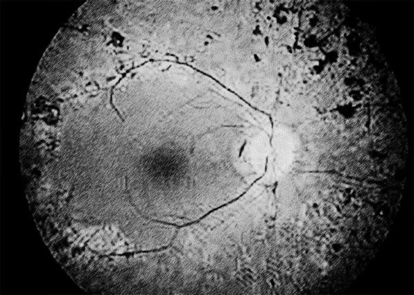 Usher Syndrome – Retyne.com